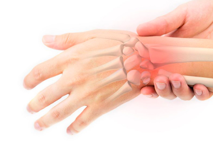 Tout savoir sur la fracture des os du carpe| Institut de kinésithérapie